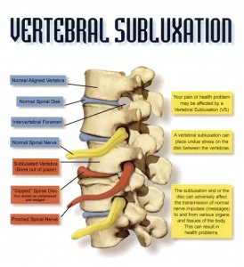What causes subluxation to occur?? – Yost Family Chiropractic – (515 ...